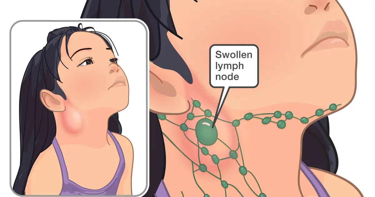 Swollen Lymph Nodes