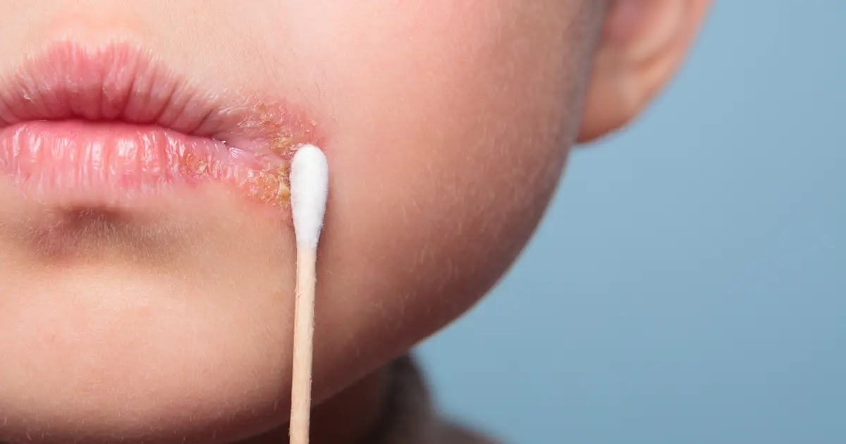 Feux sauvages (boutons de fièvre ou Herpes simplex)