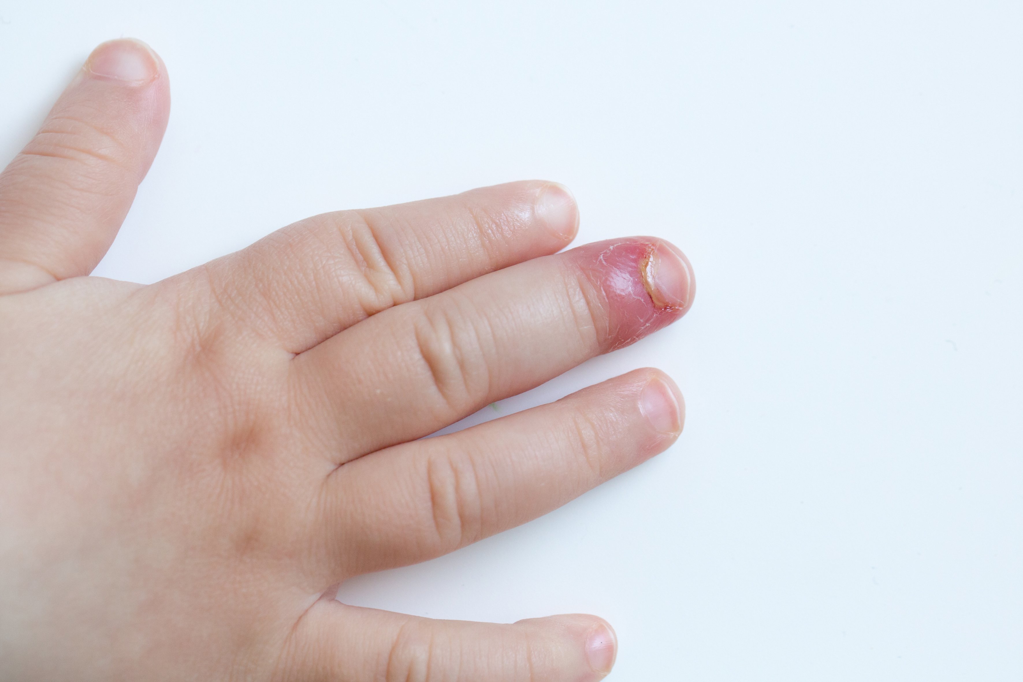 Fingernail infection paronychia