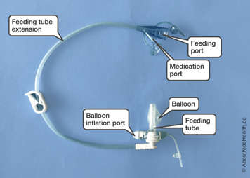 G tubes: Balloon G tubes