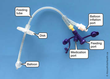 G tubes: Balloon G tubes