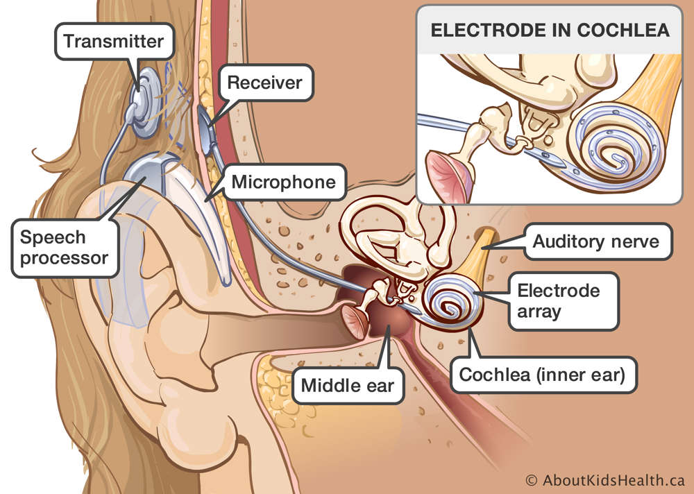 Parts Of A Cochlear Implant Diagram