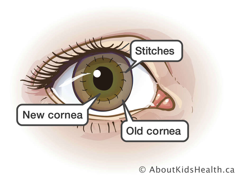 Corneal Transplant Stitches Corneal Surgery | Corneal Transplantation