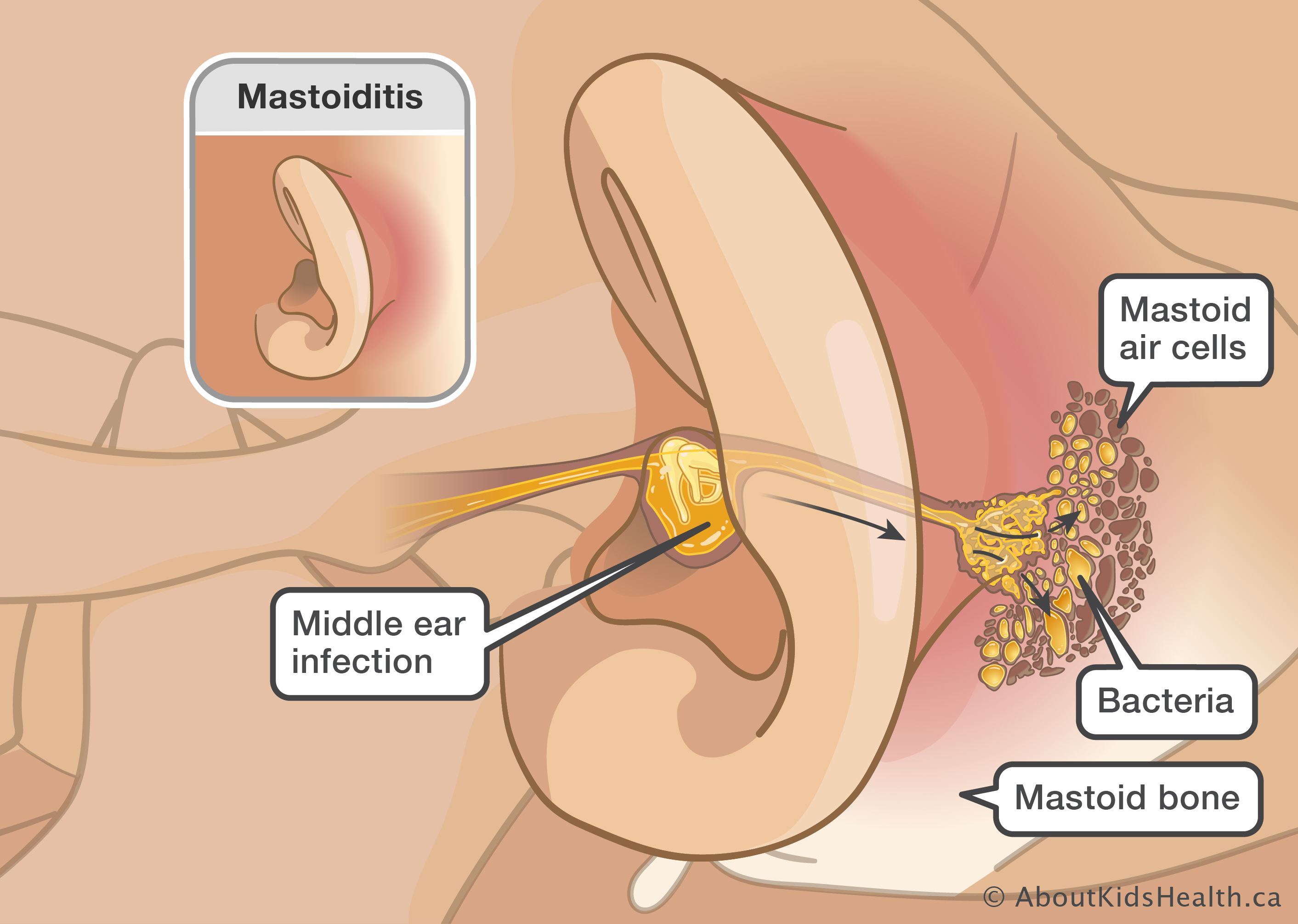 Mastoid Air Cells Anatomy Mastoid Air Cells Anatomy