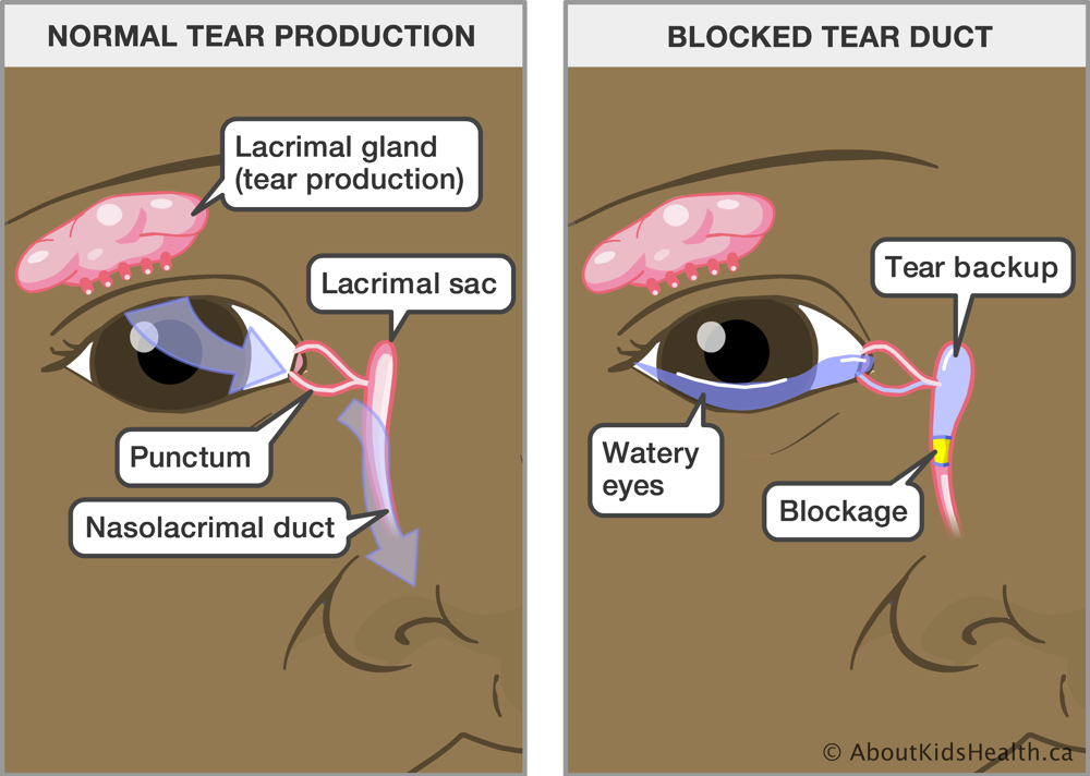 Nasolacrimal Duct Clogged Tear Duct?? : R/newborns