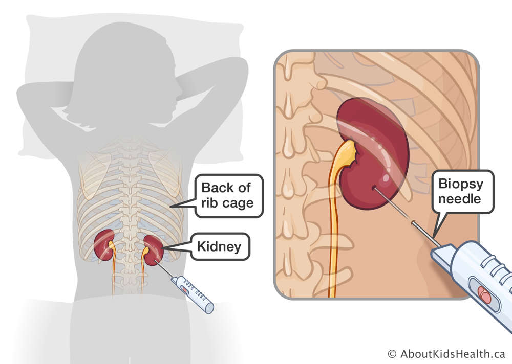 Kidney Biopsy Tissue Histopathology Of Kidney Biopsy Tissue . (a)
