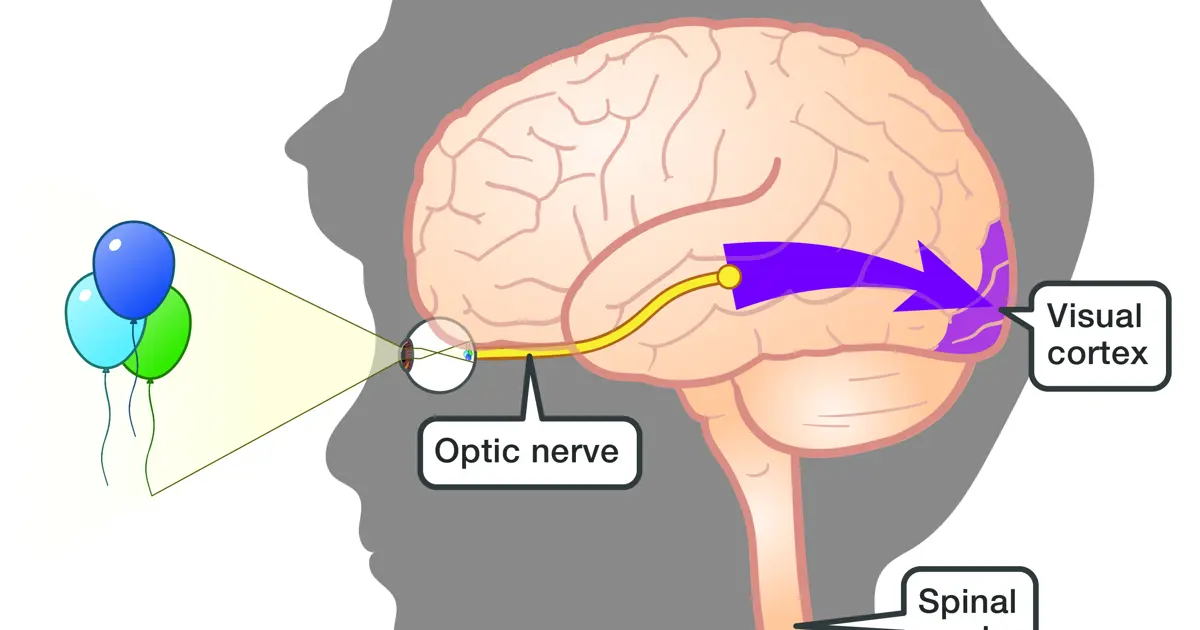 is optic neuritis common
