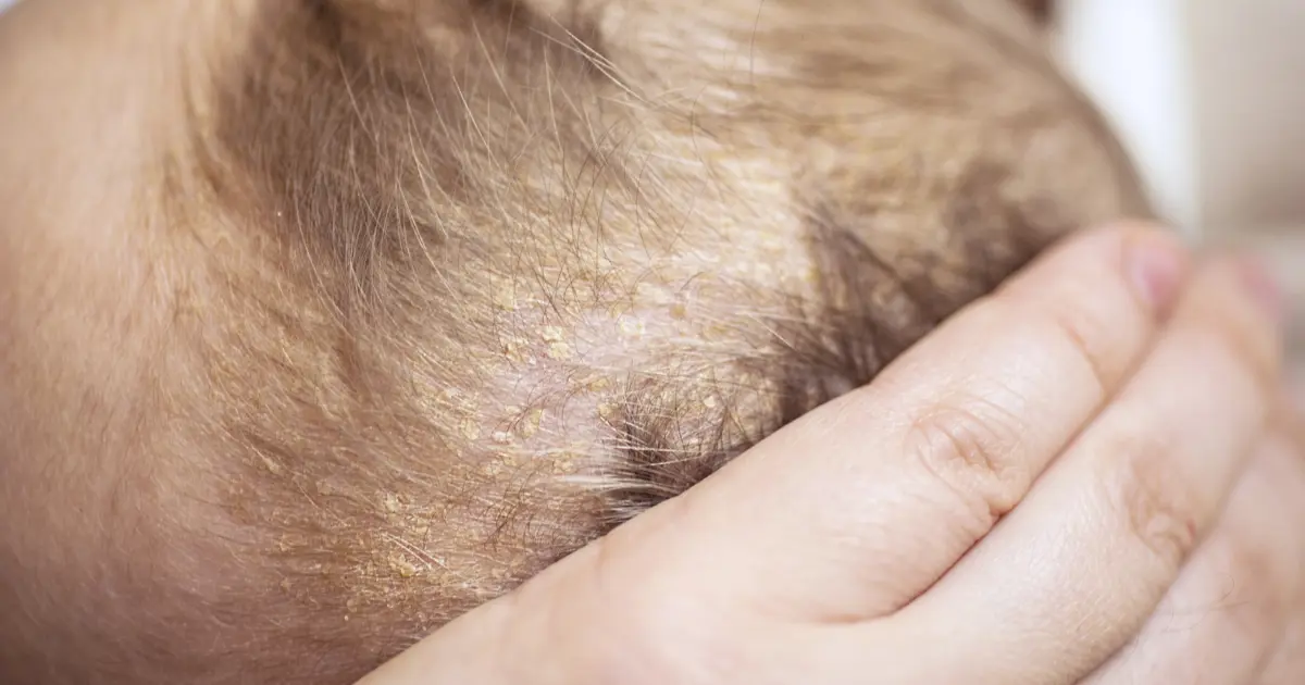 Skin conditions and birthmarks in newborns